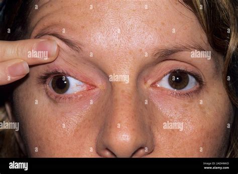 Oculomotor Palsy Face Of A 36 Year Old Woman With Oculomotor Nerve Palsy After Surgery To