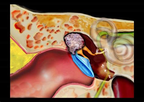 Cholesteatoma Removal Giant Cholesteatoma Case And Literature Review