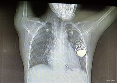 疑似被投毒百草枯病例分享 医联