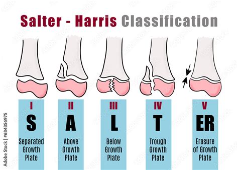 Salter Harris Classification To To Recognize And Identify Different Types Of Bone Fractures