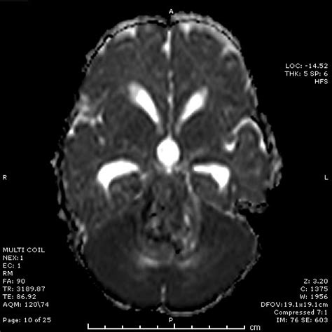 Pediatric Tumors Detection Instance Segmentation Model By Blue