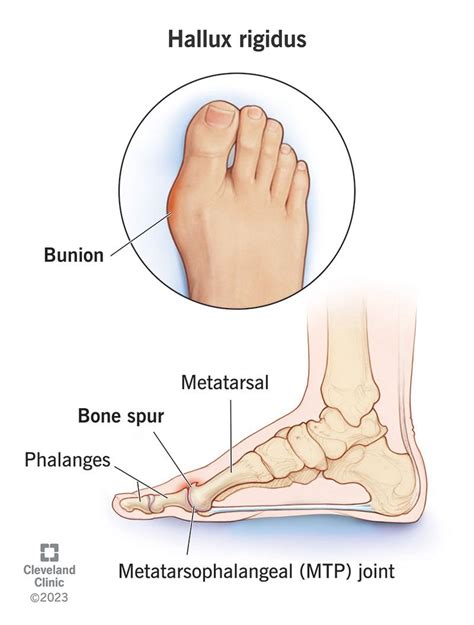 Painful Big Toe Artofit