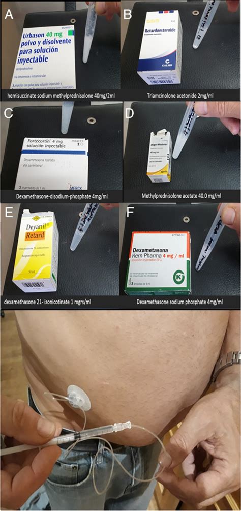 A Novel Method Of Treating Apomorphine‐induced Subcutaneous Nodules Pmc
