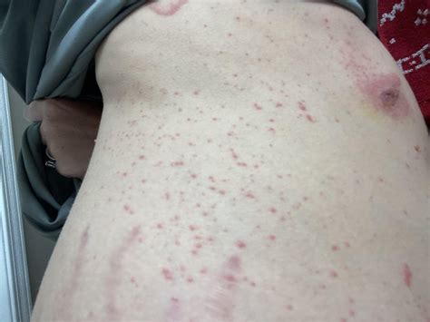 Itchy Rash After Surgery Not Allergic Contact Dermatitis Rdermatologyquestions