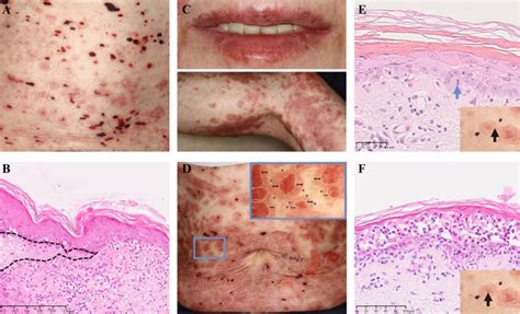 Jle European Journal Of Dermatology Erythema Multiforme Like Eruption With Severe Epidermal