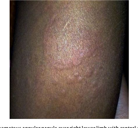 Figure 1 From Erythema Marginatum Rheumaticum Semantic Scholar