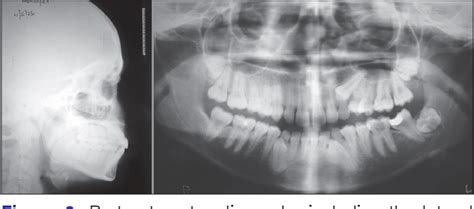 Figure 3 From Management Of Multiple Impacted Teeth Semantic Scholar