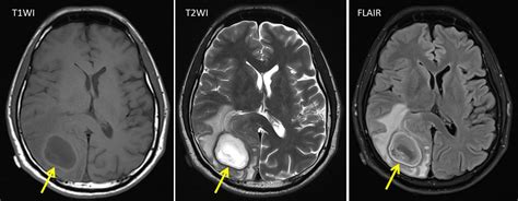 Cerebral Abscess Radiology Cases