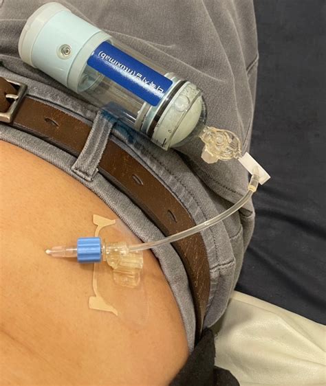 소포성림프종 유지치료 시작 네이버 블로그