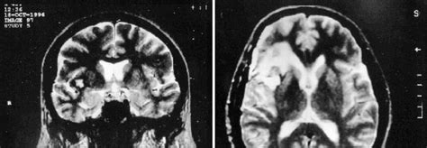 Left Pre Operative Coronal T2 Slice Showing A Right Insular Cavernoma