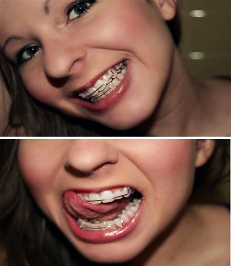 Braces Braceface Girlswithbraces Retainers Dental Braces Braces My