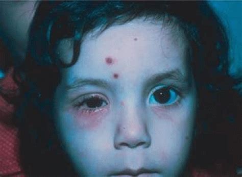 Herpes Simplex Forehead