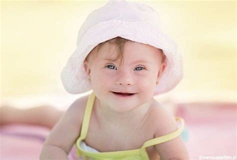 عکس نوزاد تازه متولد شده سندروم داون