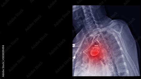 Film X Ray Radiograph Cxr Show Artificial Cardiac Pacemaker This Is Medical Device Generate