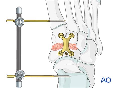 Fusion Of Unreconstructable Naviculocuneiform Joint