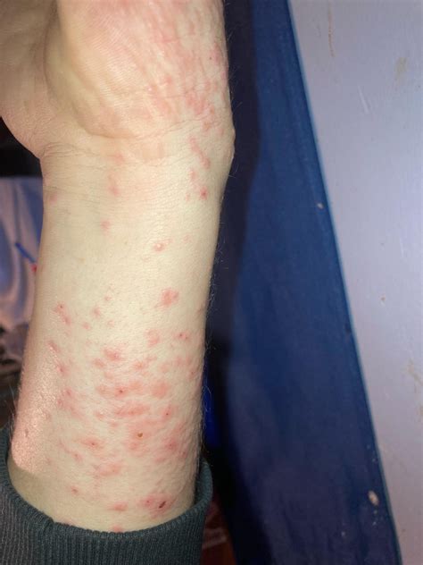 Fiberglass Rash On Hands At Jamie Heyne Blog