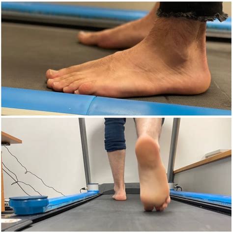 Assessment Of Selected Spatio Temporal Gait Parameters On Subjects With Pronated Foot Posture On