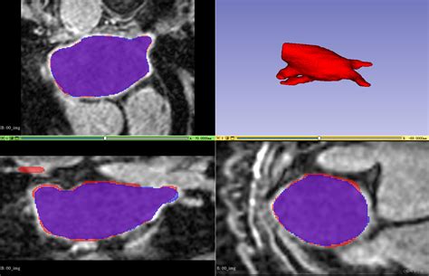 半监督3d医学图像分割(一):mean Teacher 灰信网(软件开发博客聚合) 半监督3d医学图像分割(一):mean Teacher 灰信网(软件开发博客聚合)