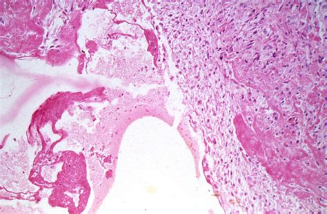 Bacterial Endocarditis Histology