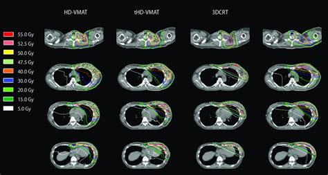 Dose Distributions Of Volumetric Modulated Arc Radiotherapy Using