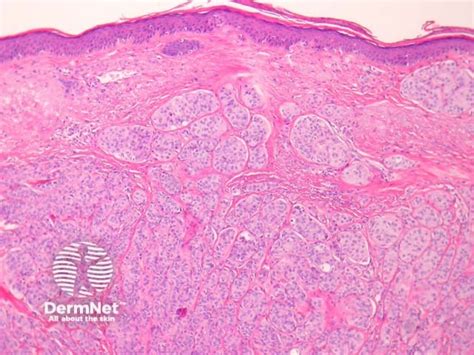 Malignant Melanoma Histology Melanoma Pathology Dermnet Nz