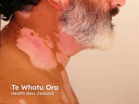 Vitiligo Images — Dermnet