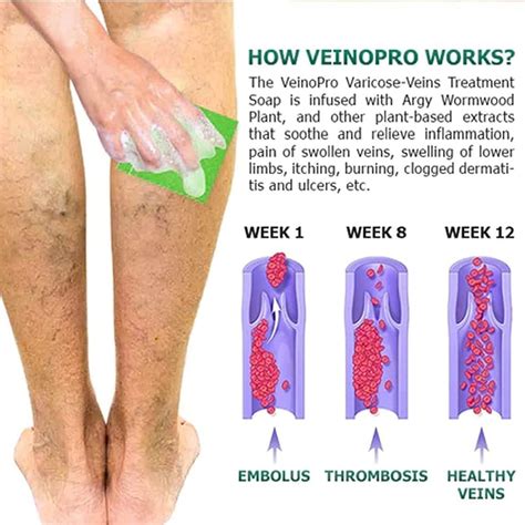 Varicose Veins Soap Natural Wormwood Formula For Spider Veins Leg Healing Pcs Buy Now