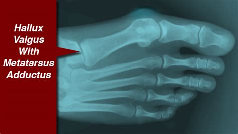 Metatarsus Adductus Angle