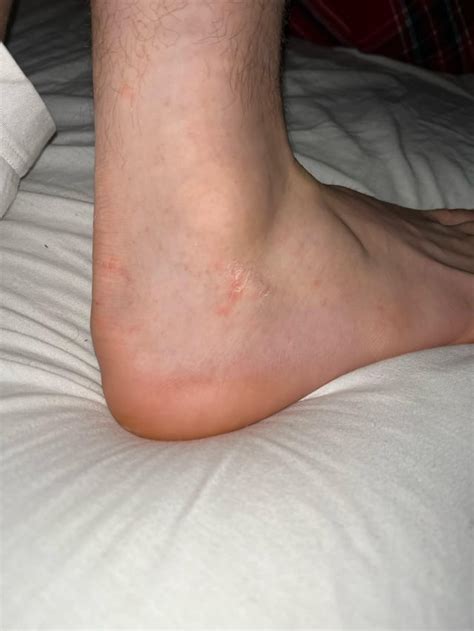 Is This Post Scabies Or Active Scabies Rscabies