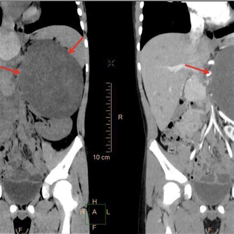 Ct Showed A Large Oval Mass Of Homogenous Soft Tissue Density Above The