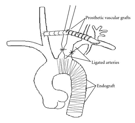 Carotid Subclavian Transposition