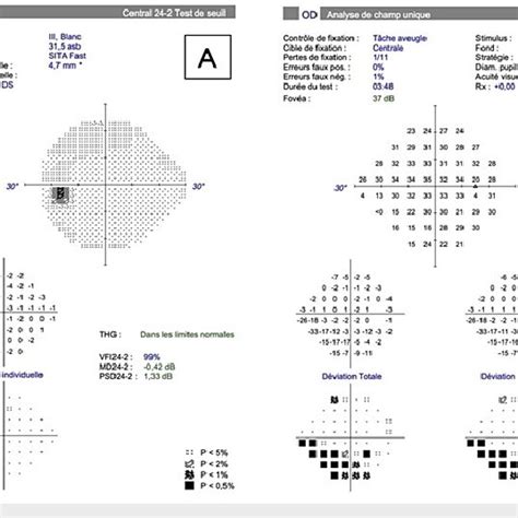Visual Field Testing Of Od And Os On 24 2 Sita Fast Humphrey Field