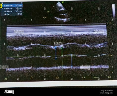 Echocardiography Or Cardiac Ultrasound Shows Normal Values Except For