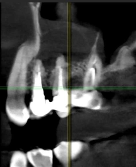 Возможно ли сохранить зуб Терапия Форум стоматологов стоматологический форум