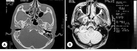 Figure 2 From A Case Of Glomus Jugulare Tumor Treated By Preoperative