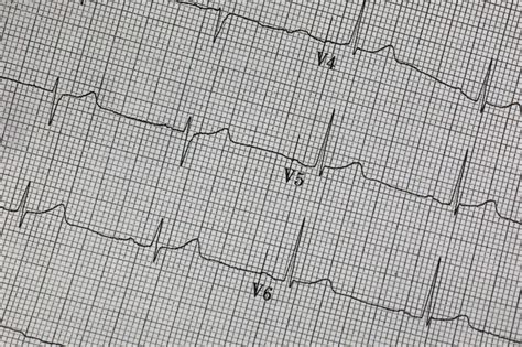 New Studies Ai Captures Electrocardiogram Patterns That Could Signal A Future Sudden Cardiac Arrest