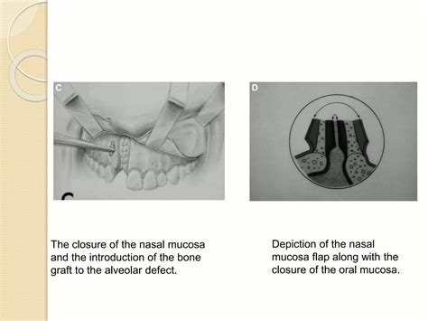 Alveolar Bone Grafting Pptx
