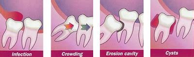 Do Wisdom Teeth Cause Crowding Alizadeh And Schreiner