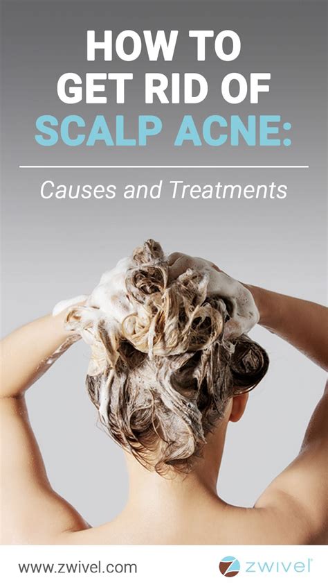 How To Get Rid Of Scalp Acne Causes And Treatments Scalp Acne Scalp Acne Treatment Pimples