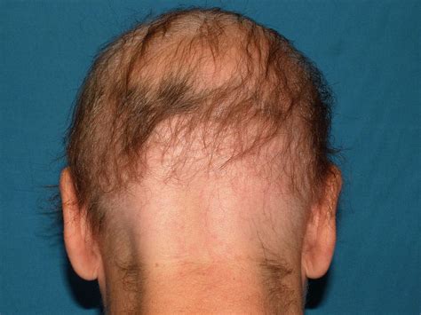 Celiac Disease Gluten Sensitivity And Skin Issues