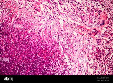 Genial Tubercle Radiograph