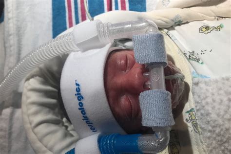 Successful Bubble Cpap Administration Rt