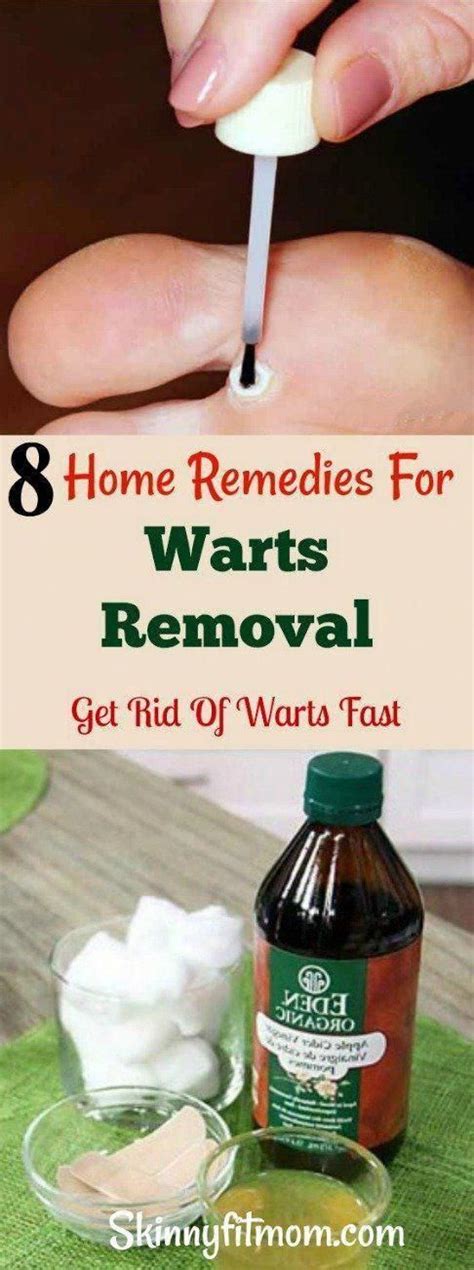 21 Effective Home Remedies To Get Rid Of Plantar Warts