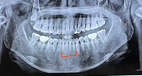 Must Pull Out Teeth Pls Help Raskdentists