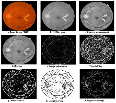 diagnostics free full text automatic screening of diabetic retinopathy using fundus images