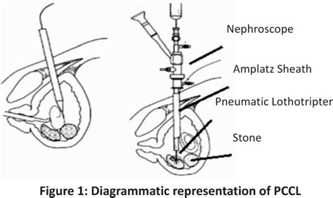Figure 1 From Percutaneous Cystolithotripsy As A Reliable Modality To