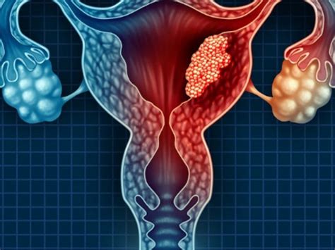 Creating Awareness On The Increasing Burden Of Cervical Cancer In Women