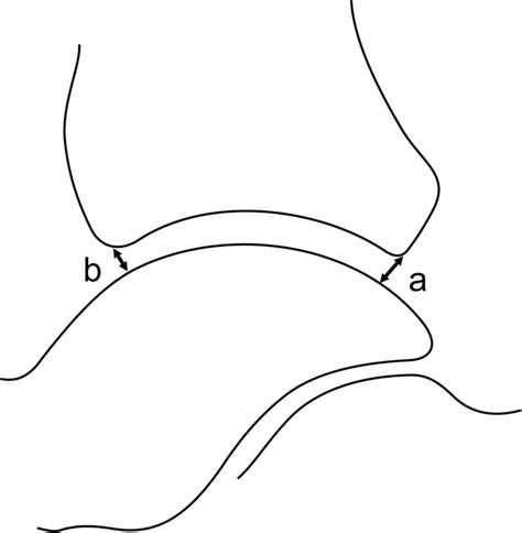 Subluxation Of The Talus A Difference Between These Two Measurements
