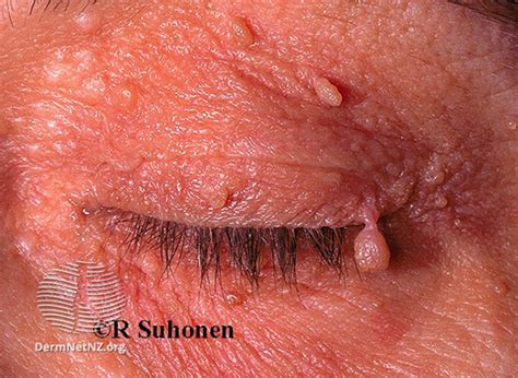 Benign Skin Lesions