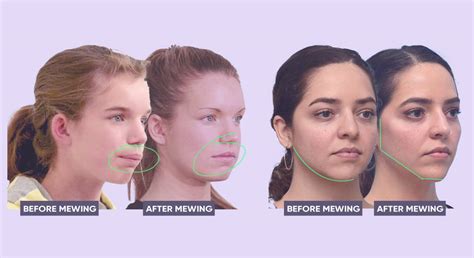 Mewing Benefits The Complete List Ach